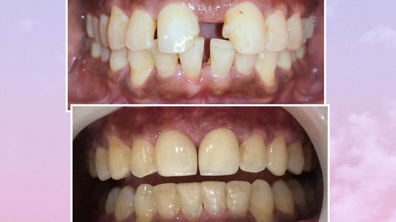 Adult orthodontics to correct spacing caused by traumatic bite ...
