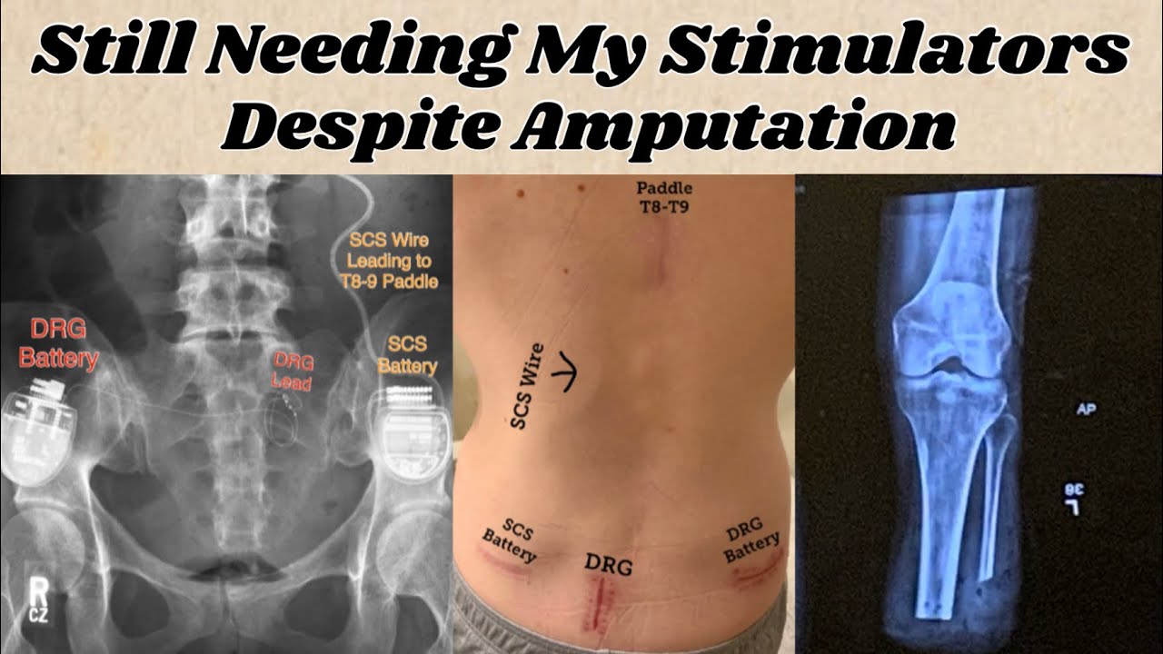 RSD to Amputee: What’s Happening with My Stimulators? - YouTube