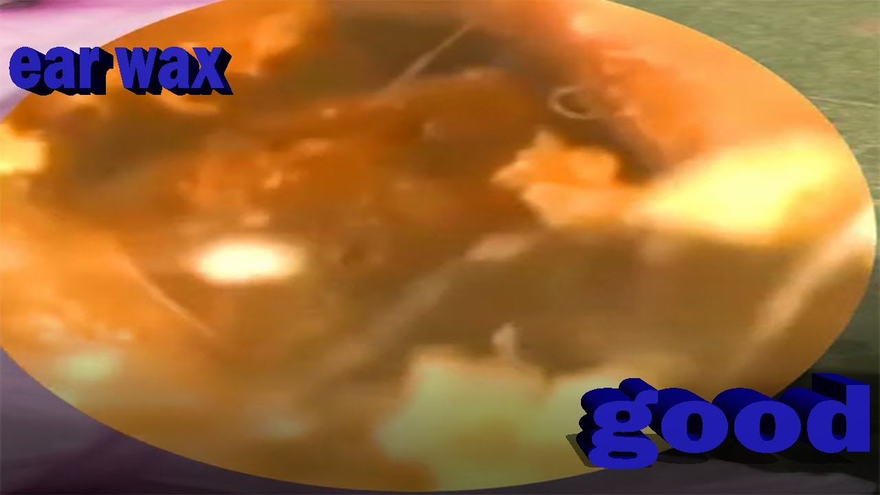 Huge Tonsil Stones Ear wax Removal in a case of Chronic Tonsillitis ...