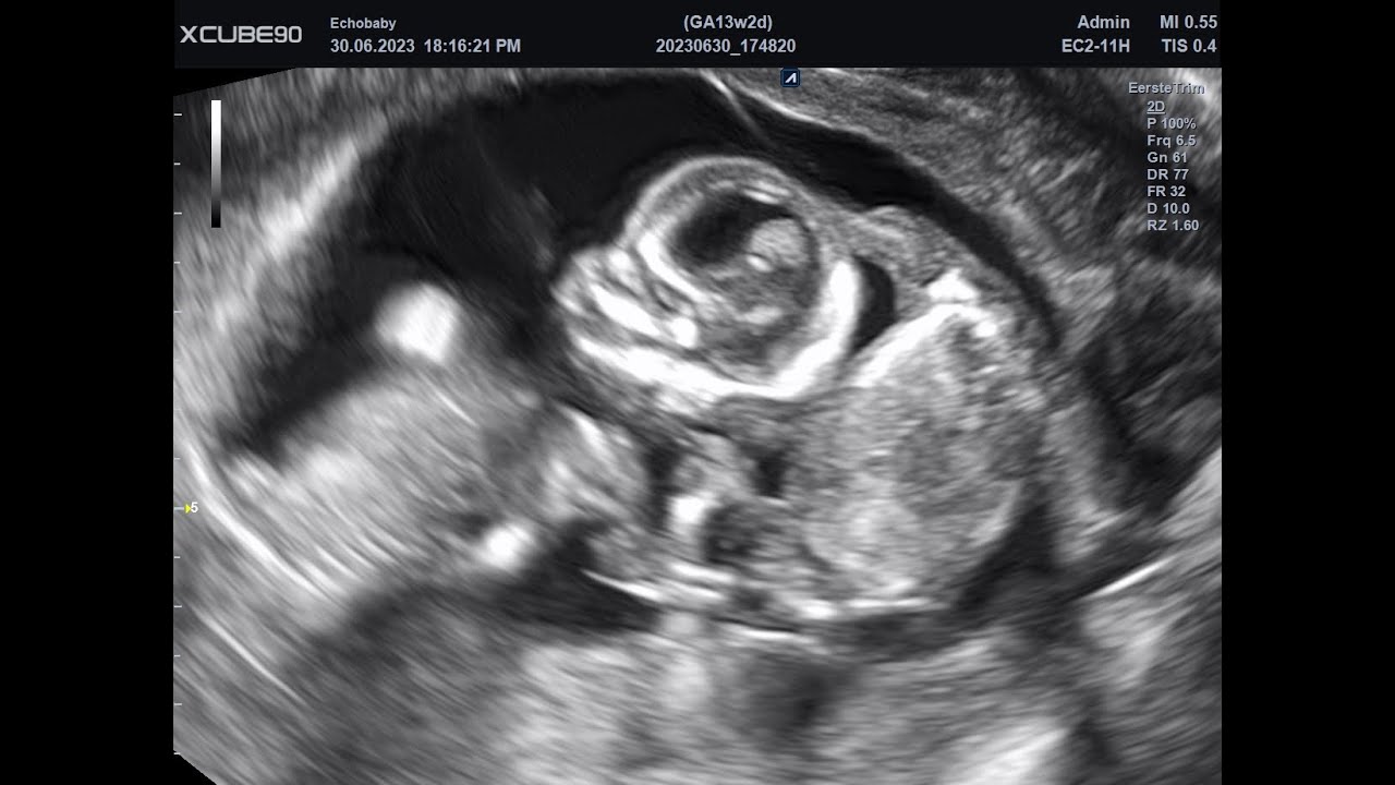 2D Echo 13 Weken Zwanger Tweeling Foto's En Filmpjes - YouTube