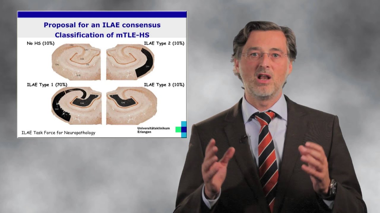 Consensus Classification of mTLE-HS - Ingmar Blumcke - YouTube