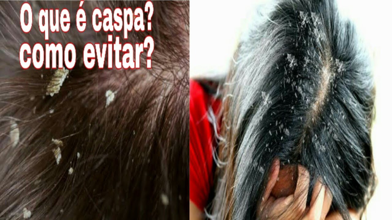 DICAS DE COMO ACABAR COM A CASPA. ENTENDA O QUE É A CASPA E COMO VOCÊ ...