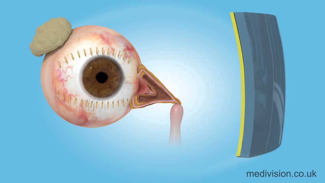 The MGDRx EyeBag - How to use it - how it treats the inflammed ...