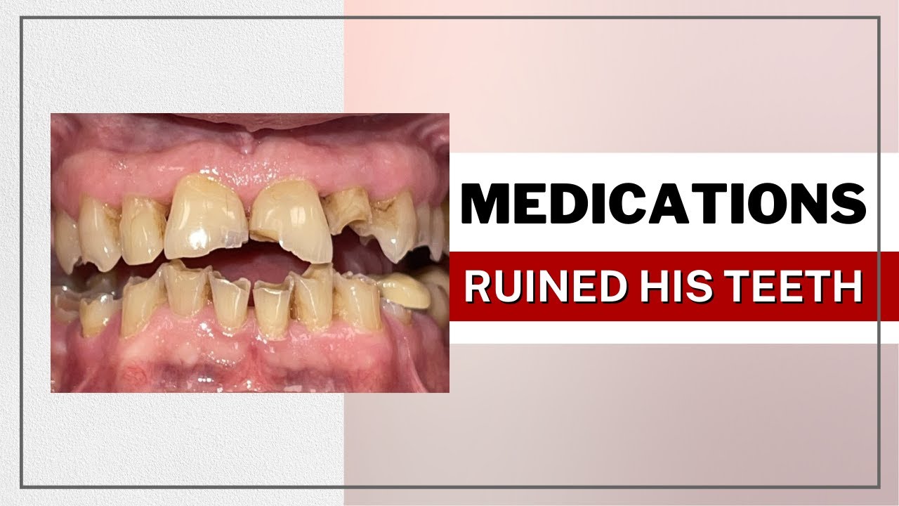 He Felt His Teeth Breaking Apart When Eating! - YouTube