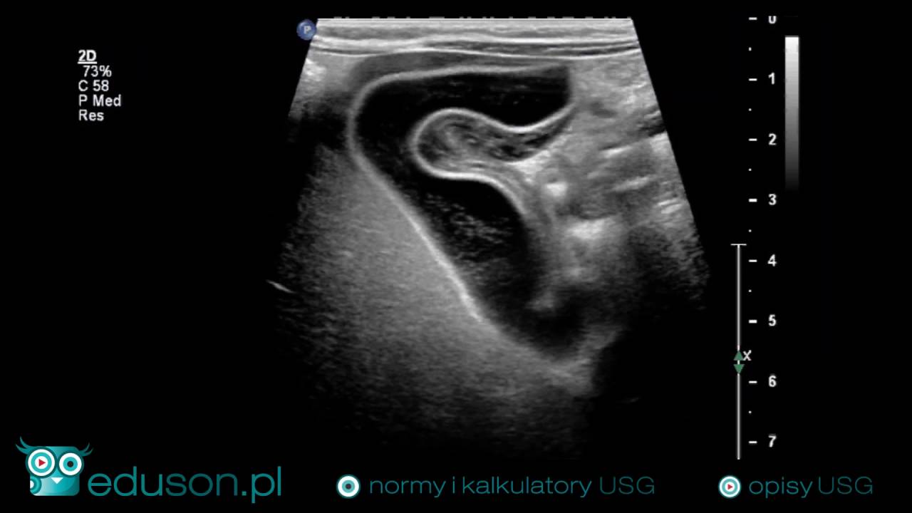 Przyczyny obrzęku ściany pęcherzyka żółciowego w badaniu usg - YouTube
