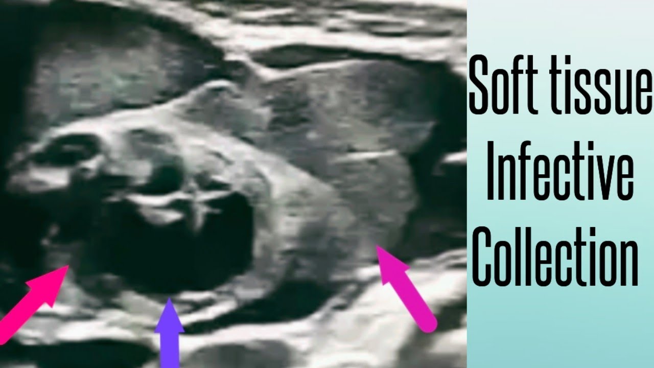 Ultrasound of the Skin and Soft Tissue Infections | Infective ...