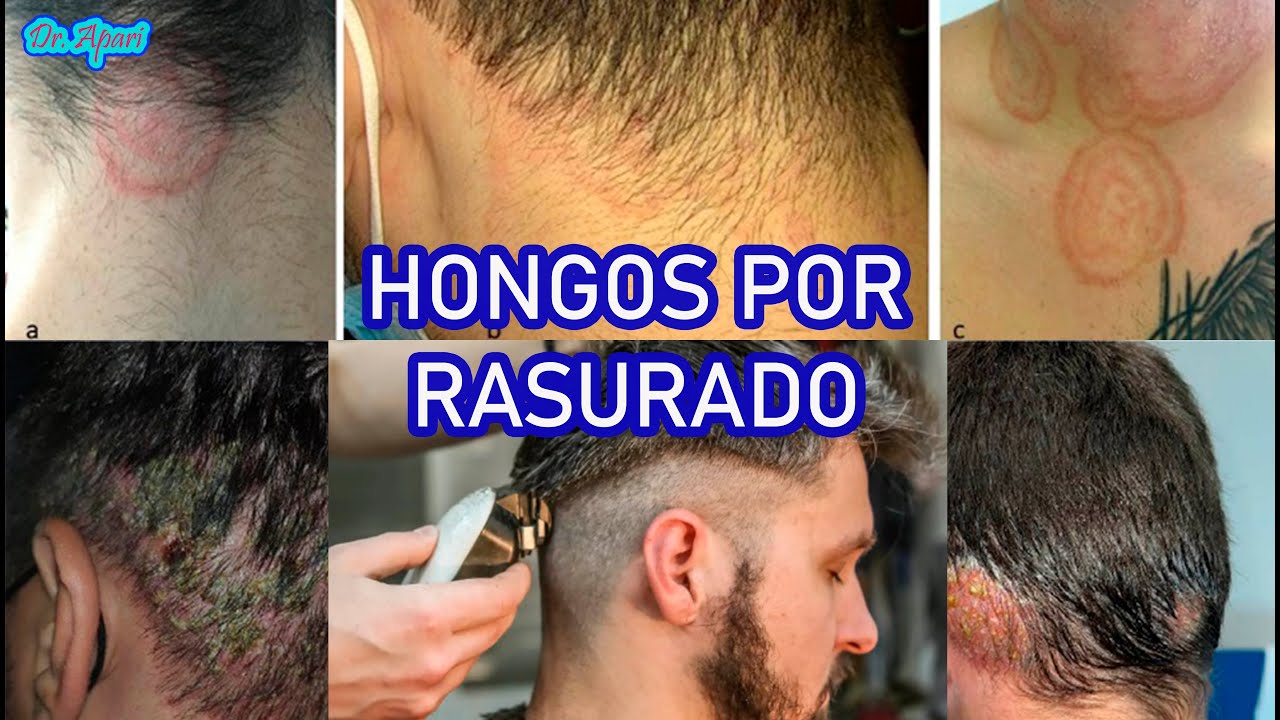 COMO ELIMINAR LOS HONGOS EN LA CABEZA POR RASURADO - YouTube