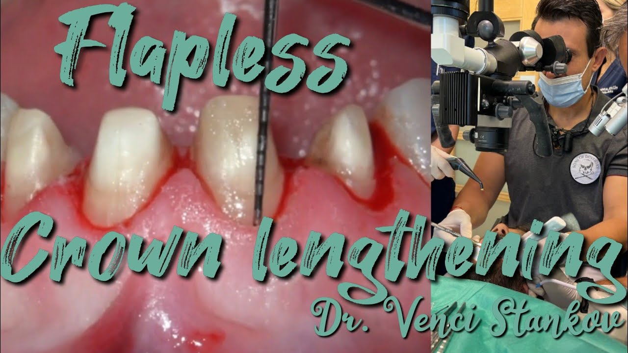 Crown lengthening technique. Dr. Venci Stankov - YouTube