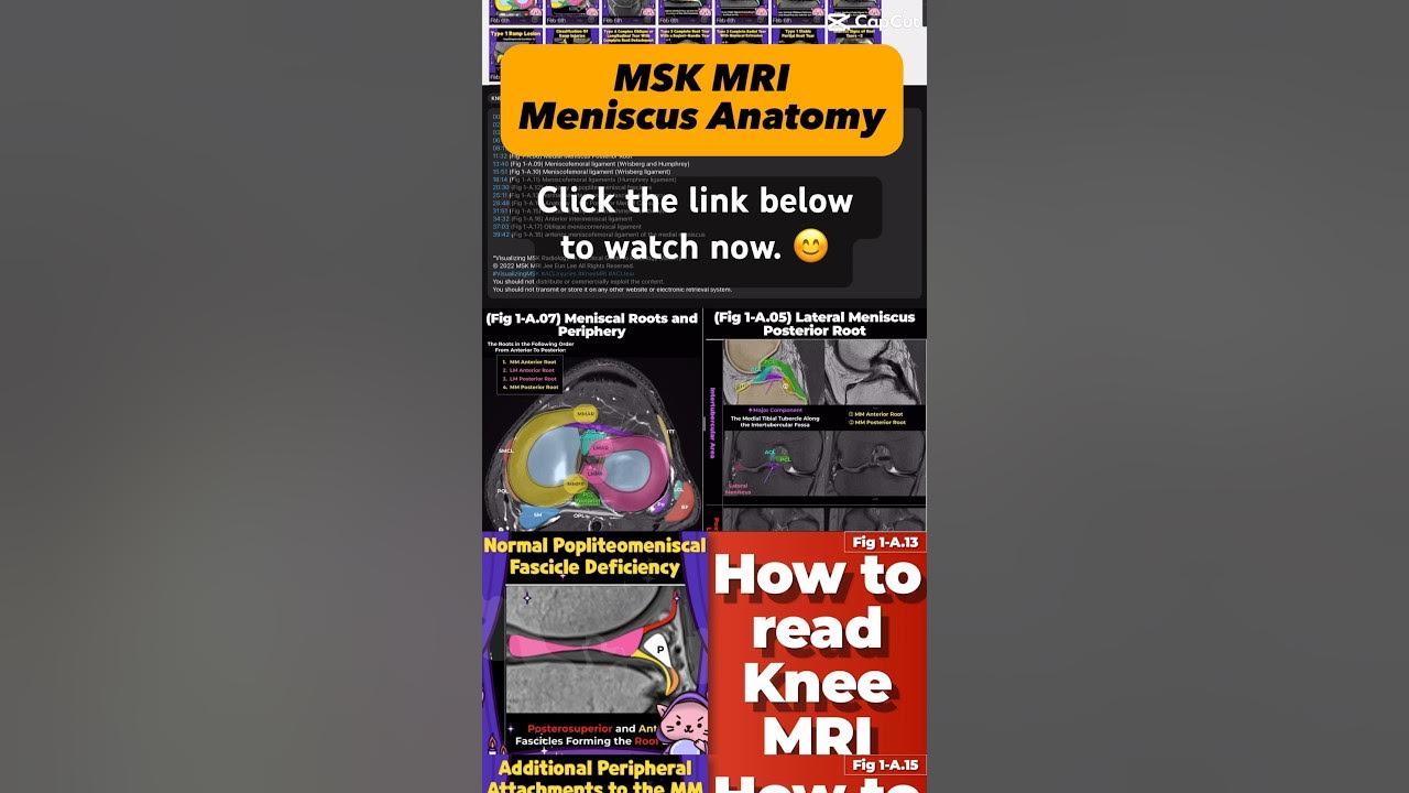 Chapter 1. A⎜Meniscus Anatomy⎜Knee MRI⎜Visualizing MSK Radiology⎜Please refer to the timeline ...