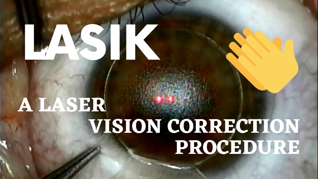 Performing a Lasik Vision Correction with Laser Eye Surgery [Quick ...