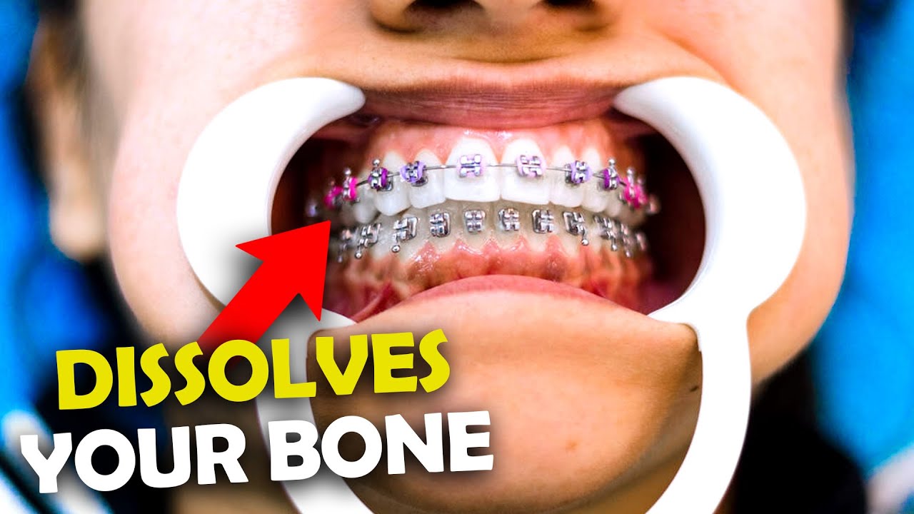 How braces actually work... - YouTube