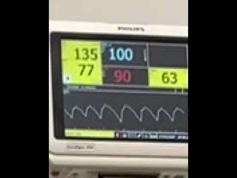NIBP Pulse rate alarm - YouTube