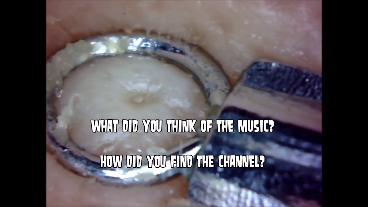 Solar Comedones and Pimple Popping - YouTube