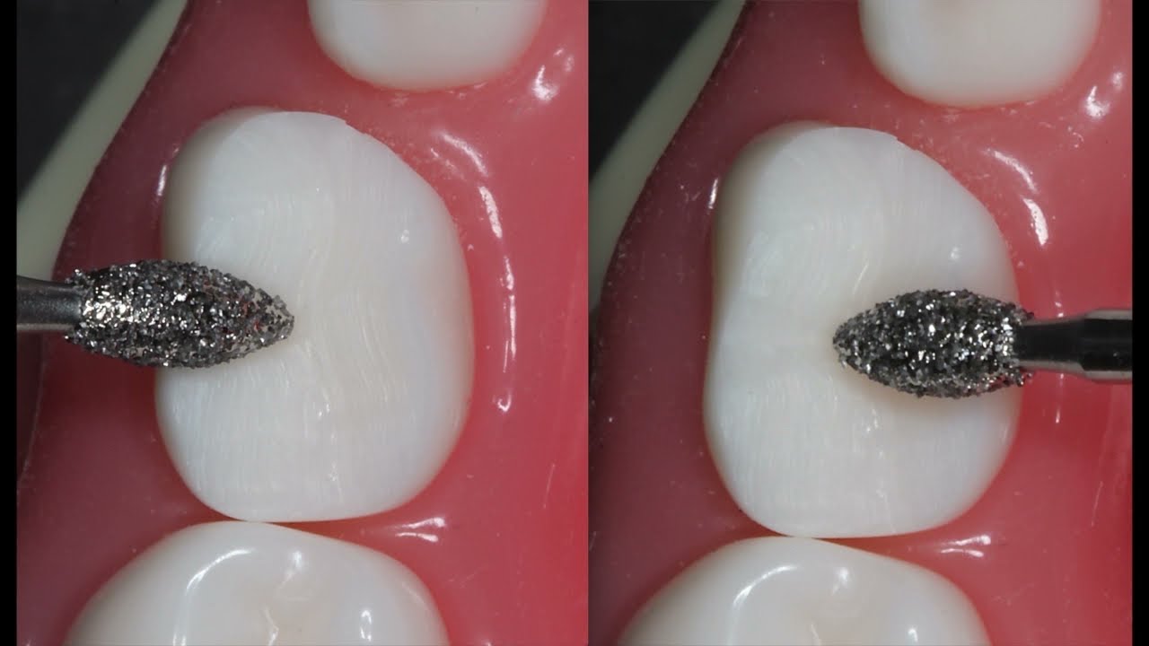 Posterior Express Prep - YouTube