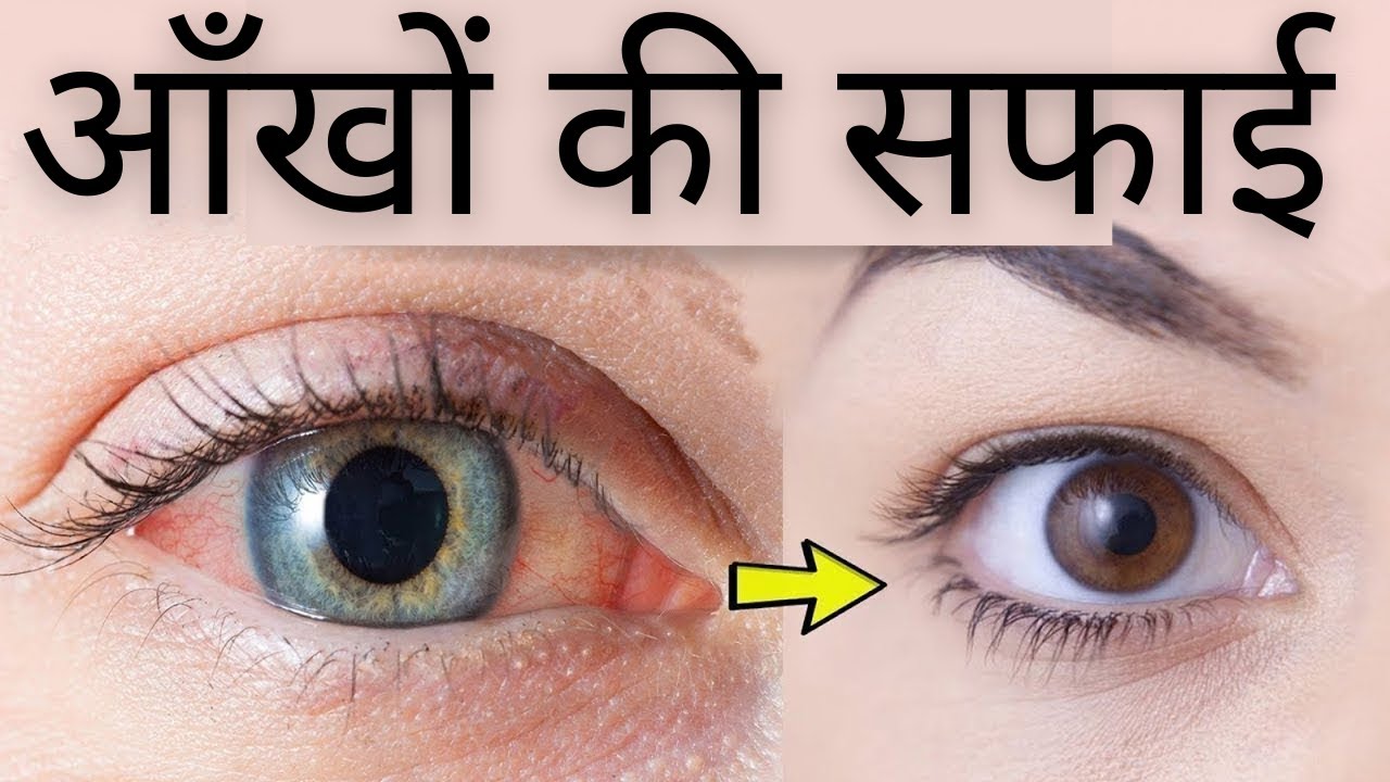 How To Get Clear And Brighten Eyes - आँखों की सफाई | Eyes Whitening ...