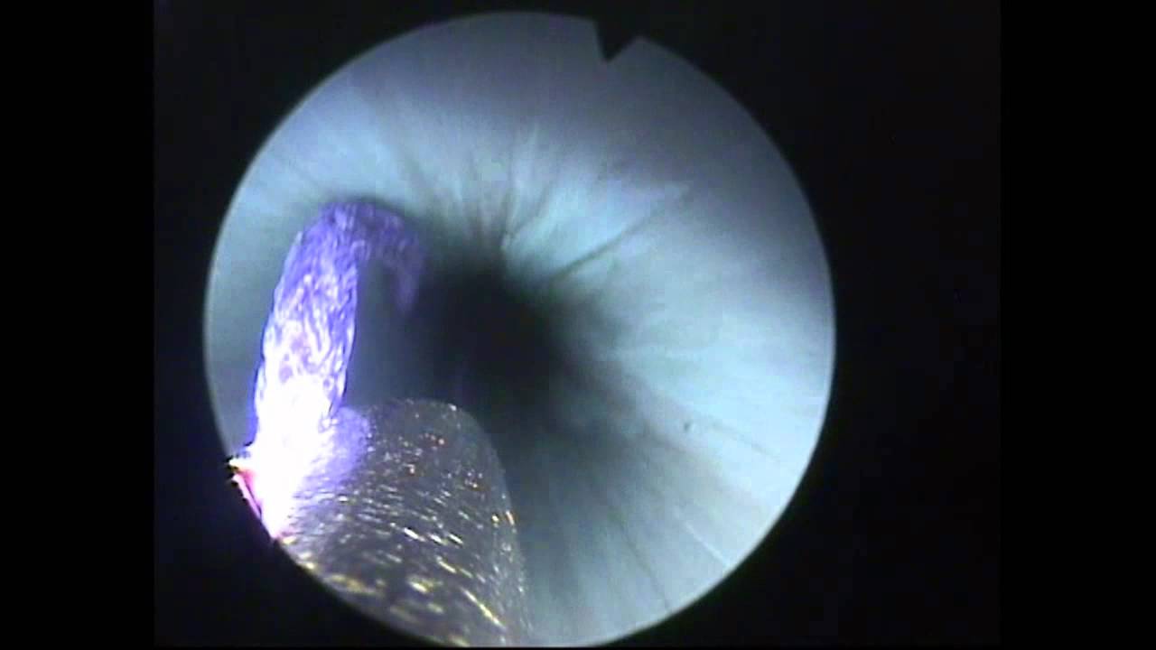 a new technique of percutaneous nephropexy - YouTube