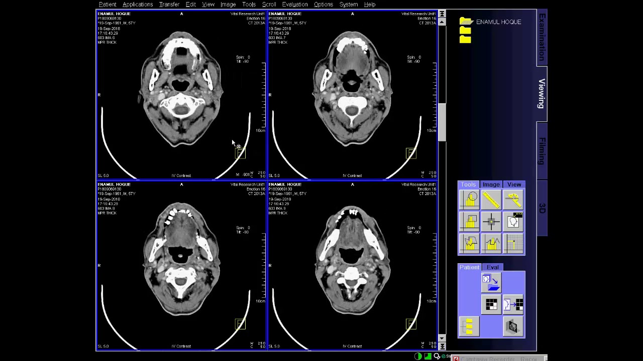 CT scan of larynx,hypopharynx filming (Neck format) - YouTube