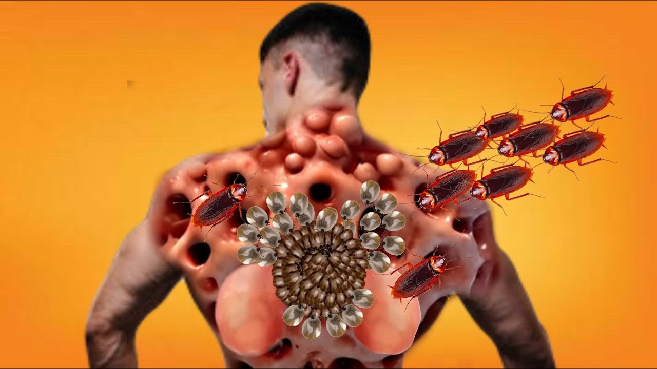 ASMR Maggots and Ticks Removal Back Man | Treatment removal infection ...