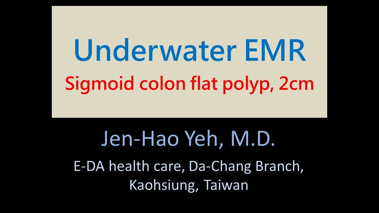 Underwater EMR for 2cm flat polyp at sigmoid colon - YouTube