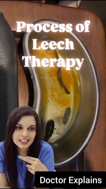 Leech therapy #drnalliramya #skincare #ent #leeching #health #healthy # ...