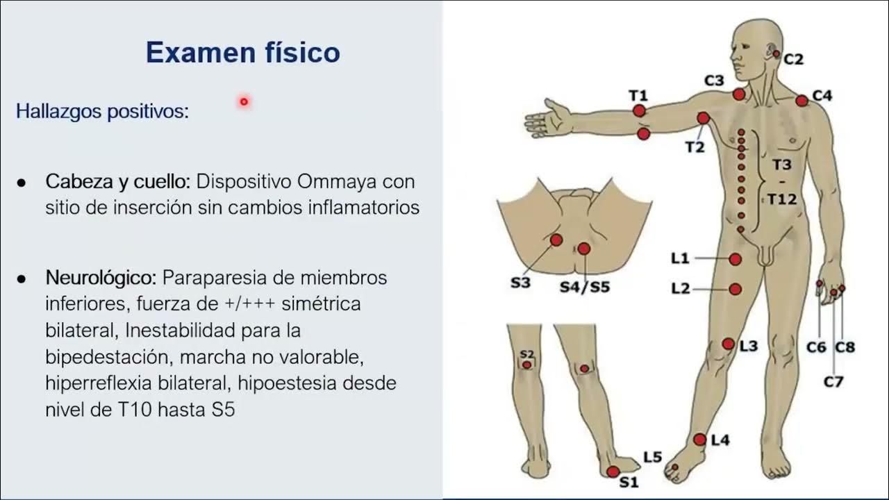 Caso clínico: Administración de quimioterapia intratecal - YouTube