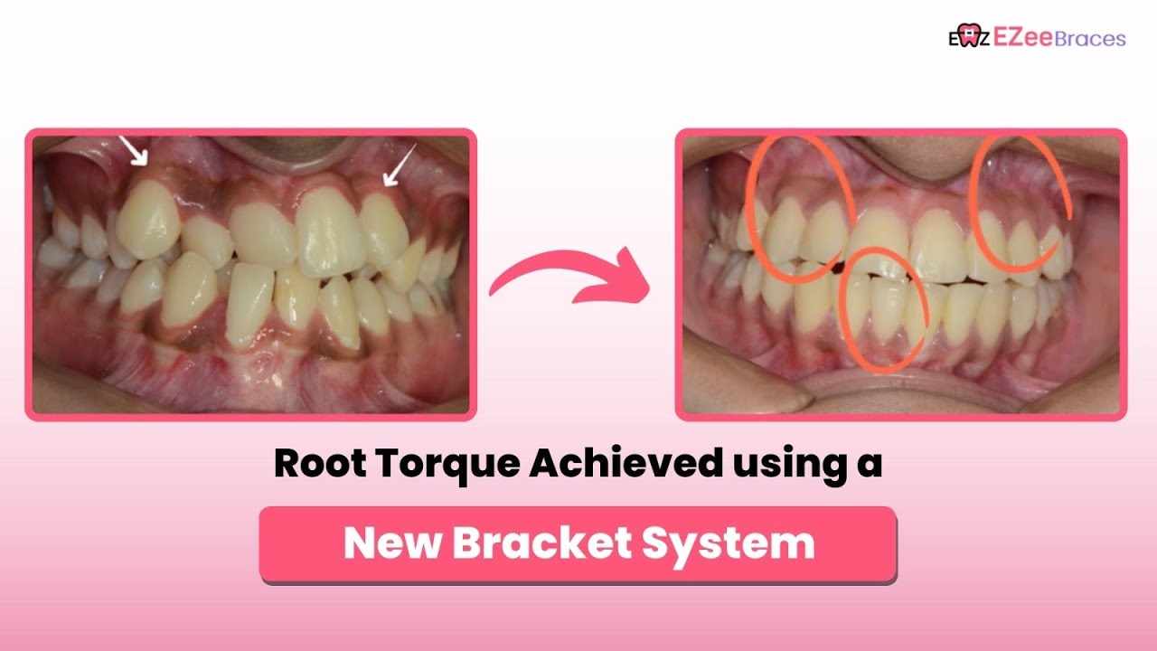 Root Torque Simplified: Managing Crowding with the Innovative BaTR ...
