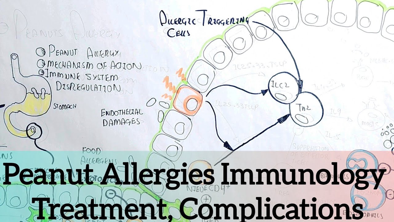 Peanut Allergies Pathophysiology, Complications, Treatment - YouTube