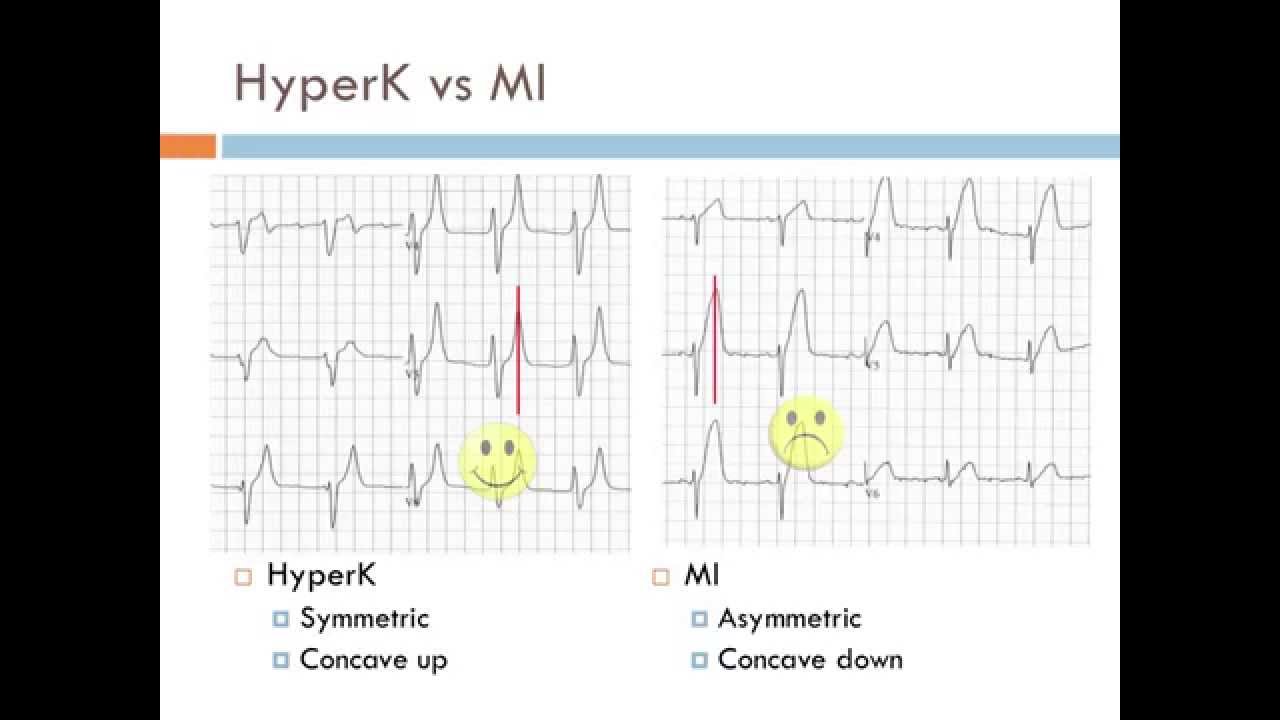 Killer EKGs - YouTube