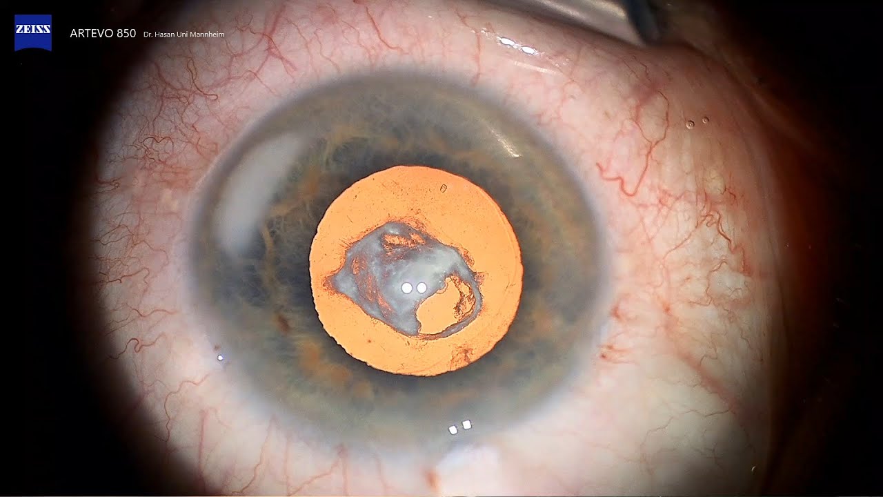 Trust your posterior capsule: Peeling Posterior Capsular Fibrosis in ...