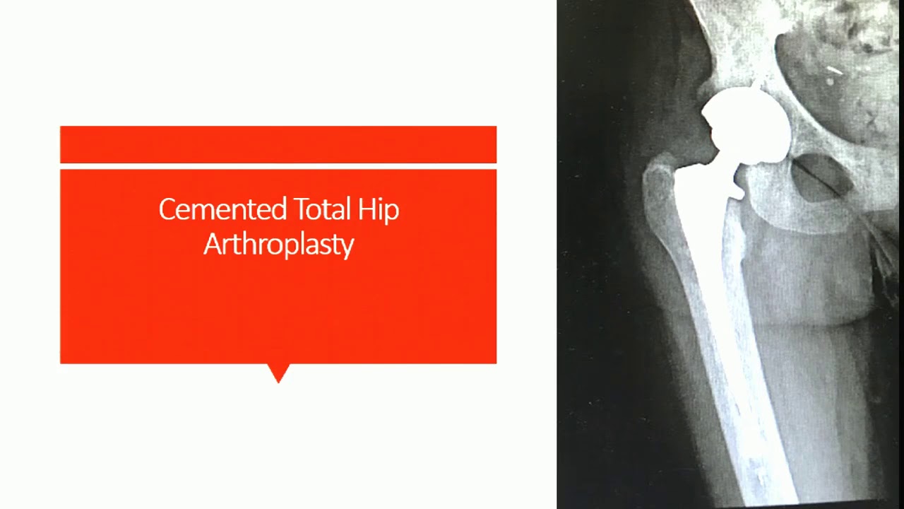 Hemi vs THA for displaced femoral neck fx - debate - YouTube