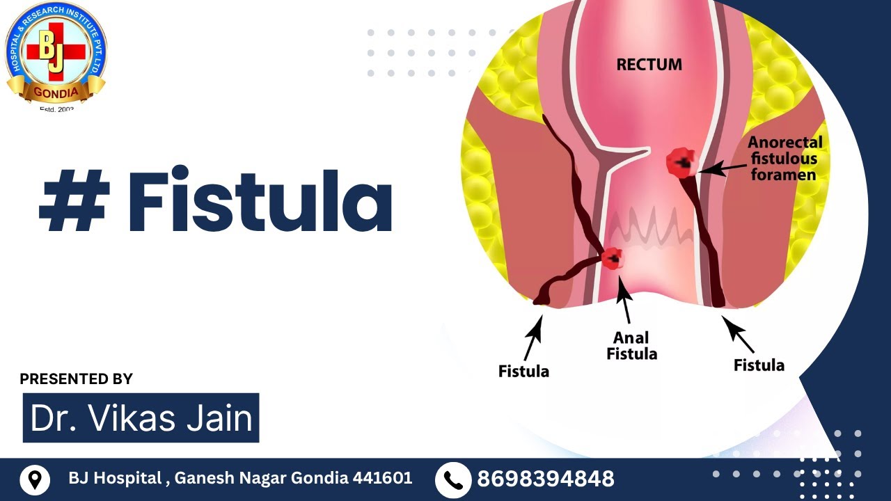 "Fistula Treatment | Step-by-Step Fistulectomy by Dr. Vikas Jain | # ...