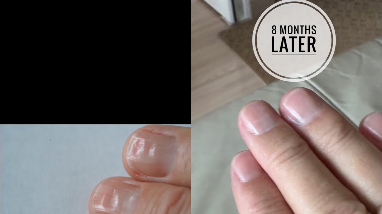 How to fix fingernail dents - YouTube