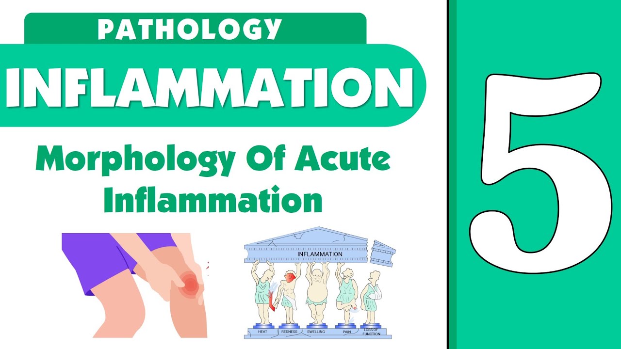 Inflammation lecture 5 : morphology of acute inflammation - YouTube