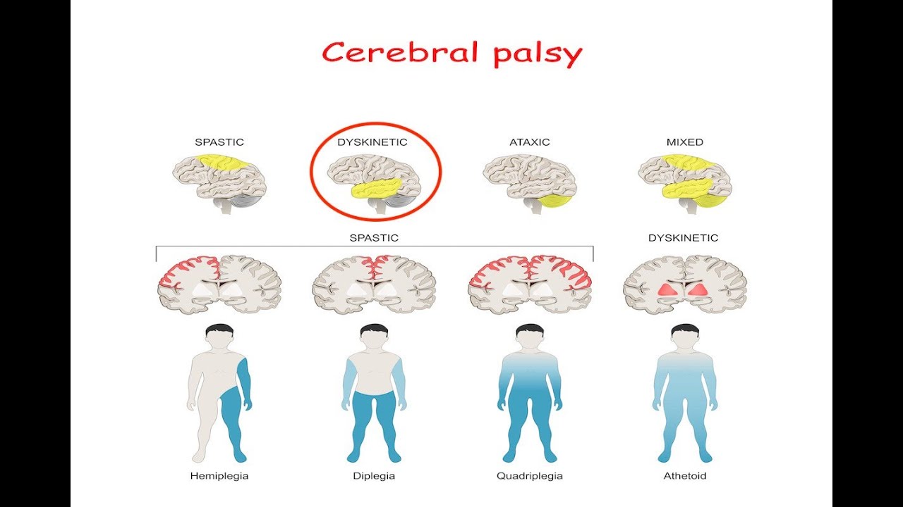 Athetoid cerebral palsy (dyskinetic cerebral palsy); Definition, Causes ...
