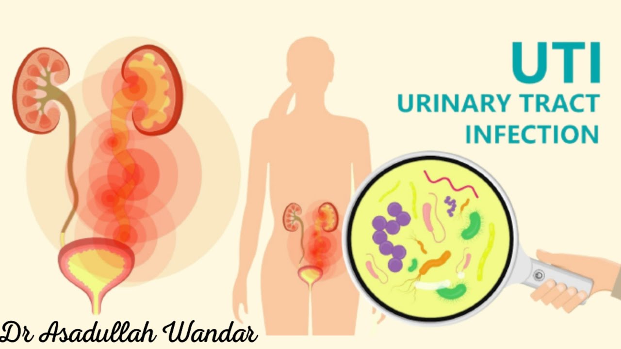 Urinary Tract Infection (UTI) ||Causes||Signs and Symptoms ||Risk ...