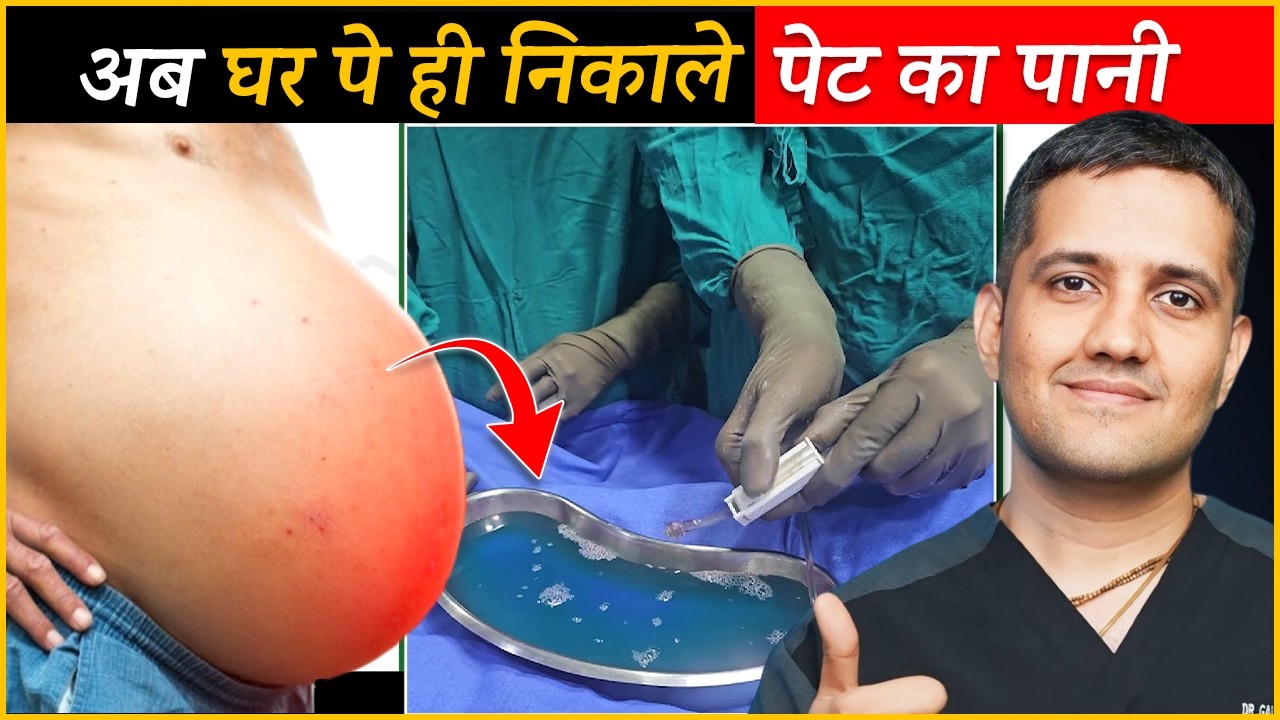 How I Removed 4.5 Liters Fluid From Patient's Belly | Dr. Gaurav ...