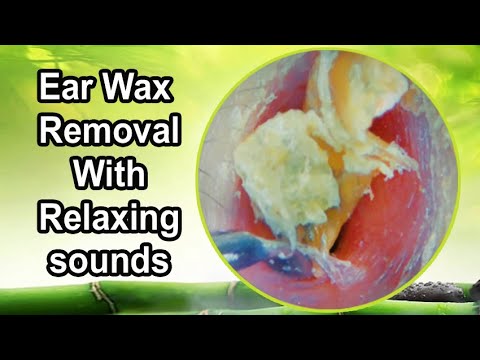 Dry ear wax removal with relaxing sound - YouTube