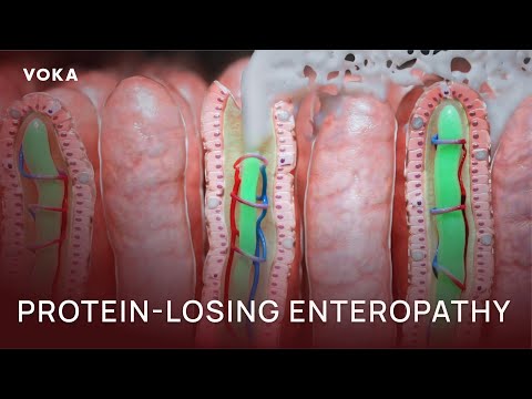 Endoscopic treatment of pathological lymphatic leakage after Fontan procedure (3D) - ESPGHAN Meeting
