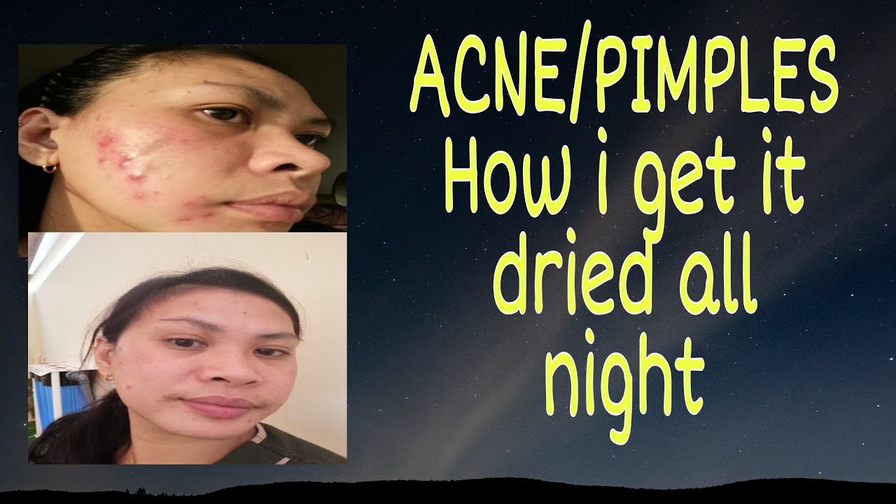 How to dry you pimples overnight /acne-pimples night ROUTINE - YouTube
