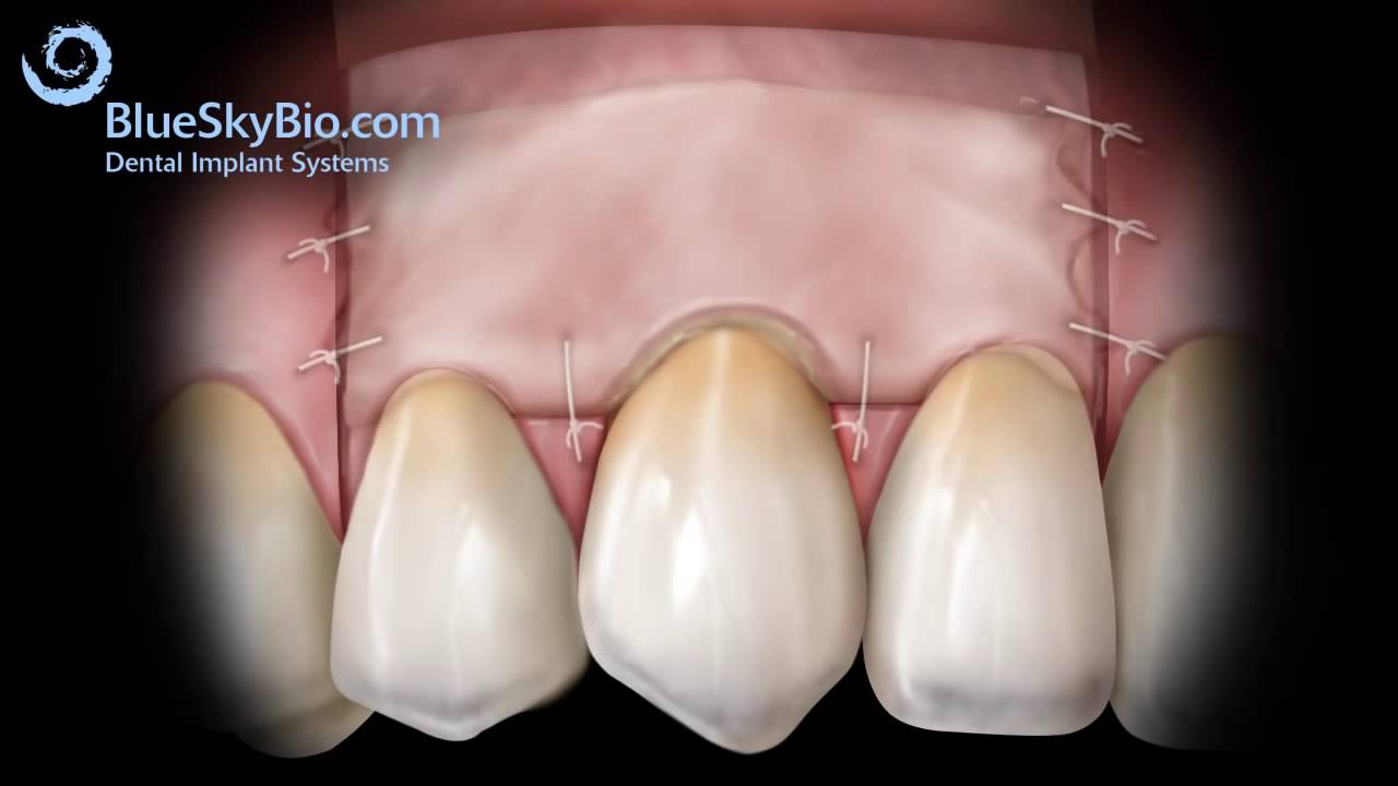 Britten Perio Shares Patient Treatment Videos Gingival Graft Alloderm ...