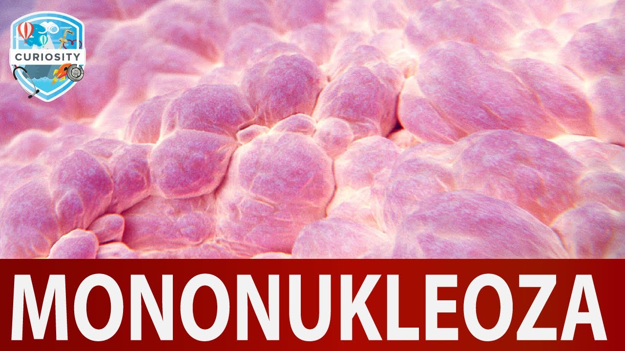 Mononukleoza Uzrok i pomoć Dr#79 - YouTube
