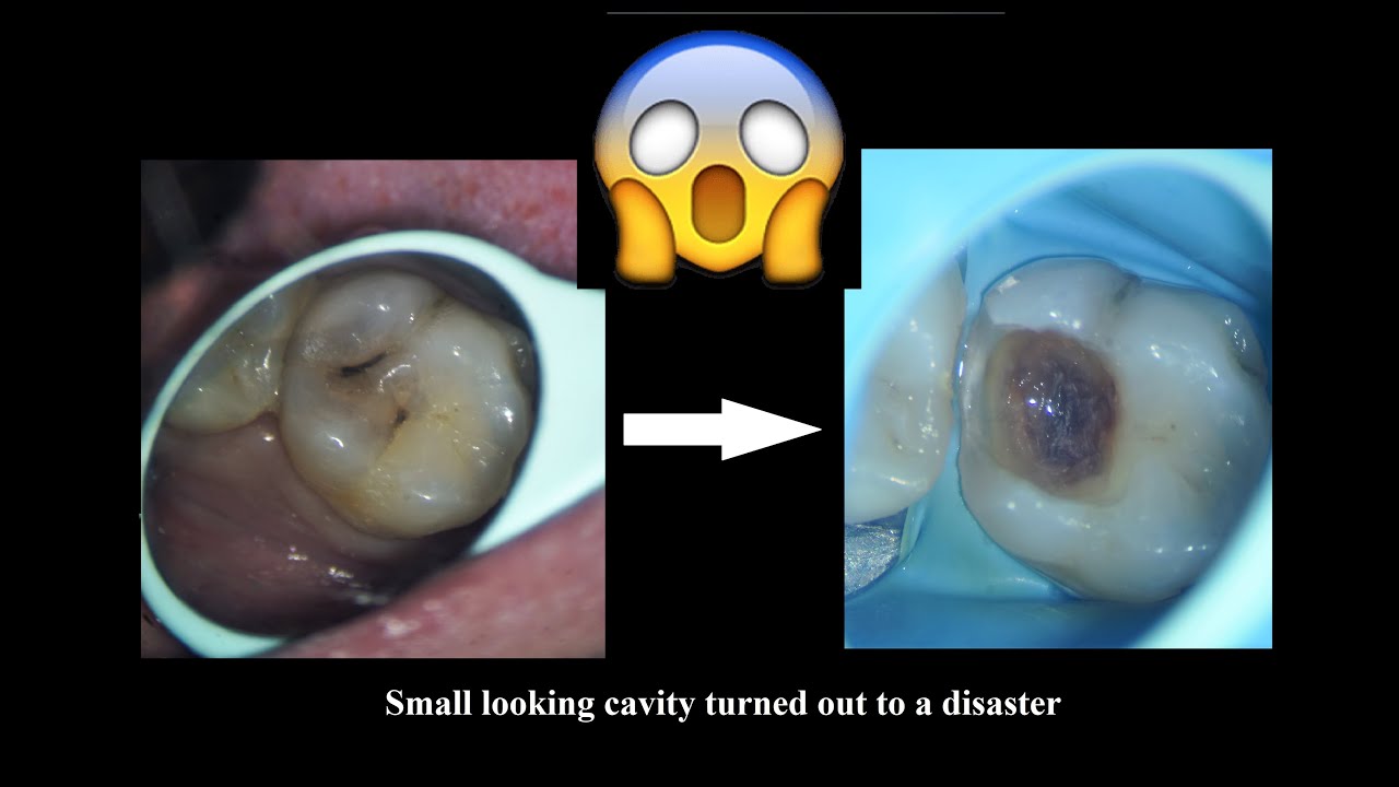 class 2 restoration step by step | composite filling live| save ...