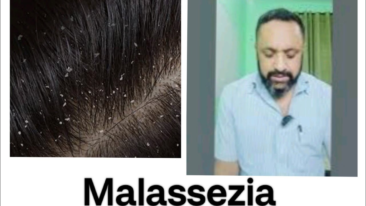 Kill Dandruff........(MALASSEZIA) Fungus/yeast - YouTube