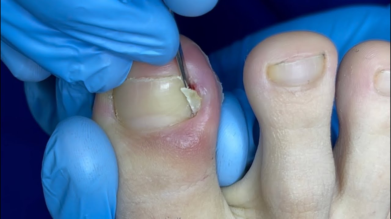 RETIRO DE UÑA ENCARNADA - YouTube