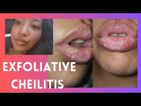 Exfoliative Cheilitis | Peeling Lips - YouTube