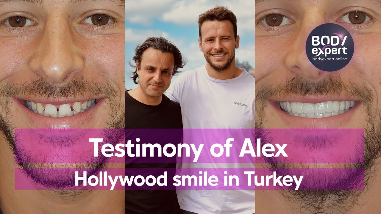 HOLLYWOOD SMILE IN TURKEY | 🦷 Alex's testimony: 22 Emax crowns ...