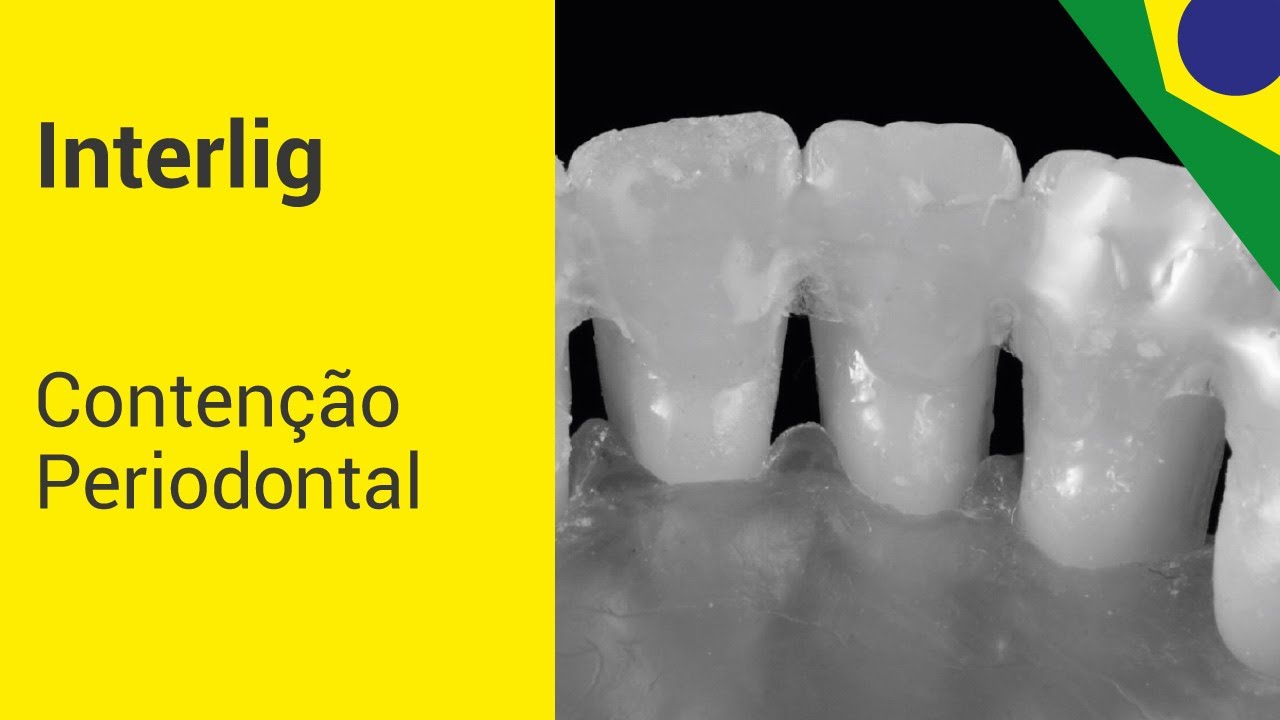 Interlig | Contenção Periodontal - YouTube