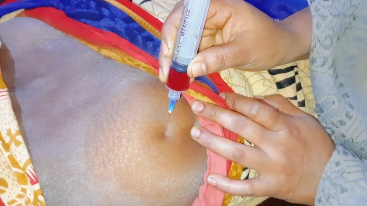 IVF Buttock Injection Vitamin B1,B6,B12 [Becobion] Injection Push 25 Ep ...