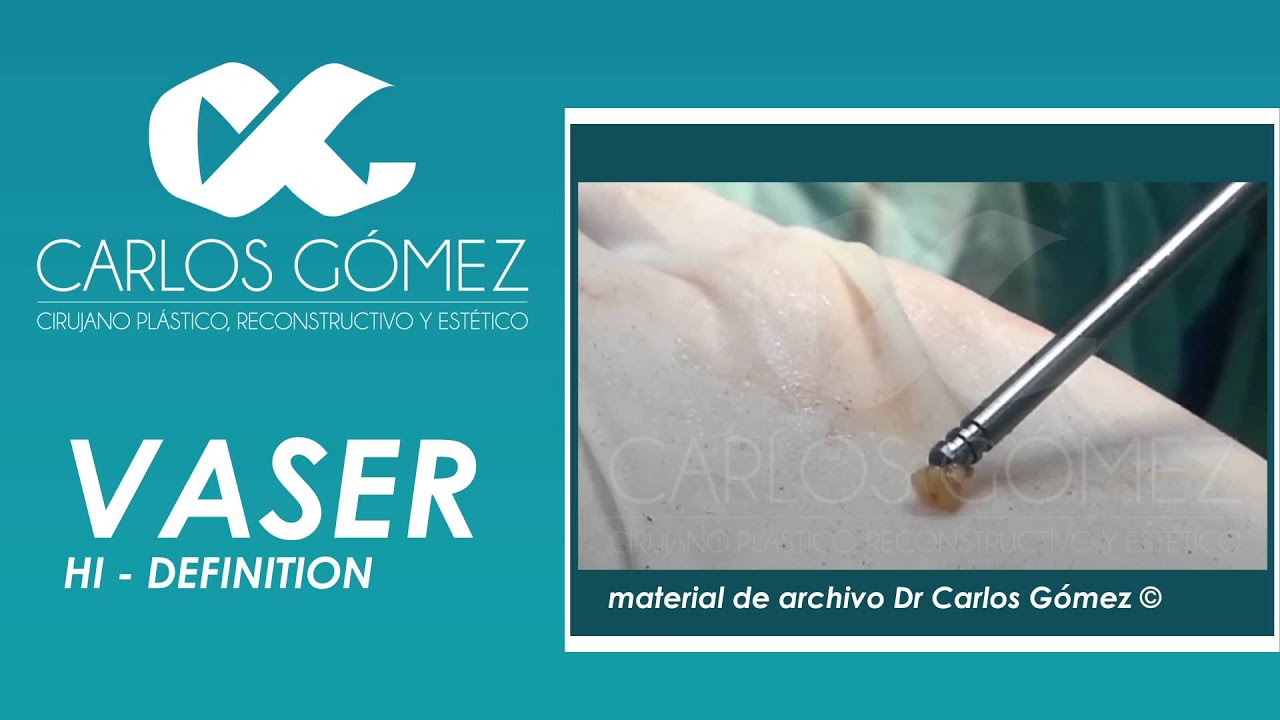 ¿QUÉ ES EL VASER ®? Tecnología de Liposucción EN HD | Procedimientos de ...