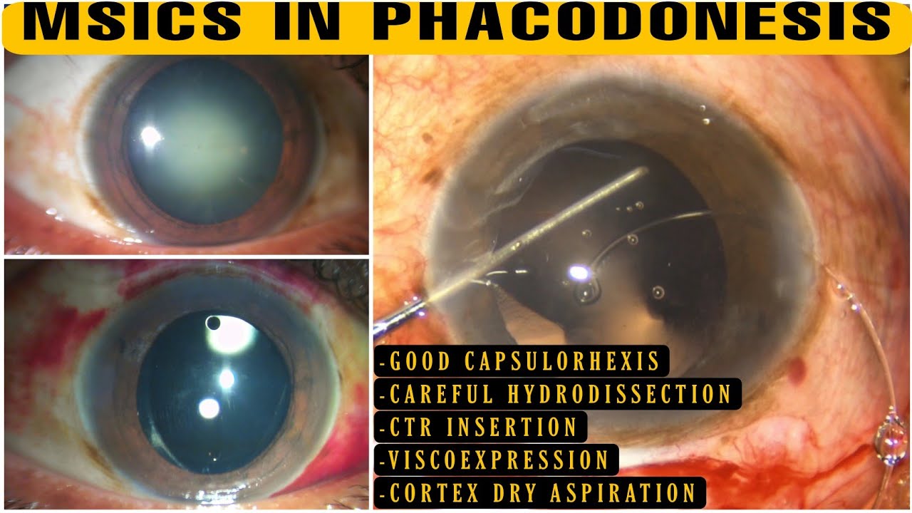 #107 Manual SICS in dense cataract with Phacodonesis | CCC | CTR ...